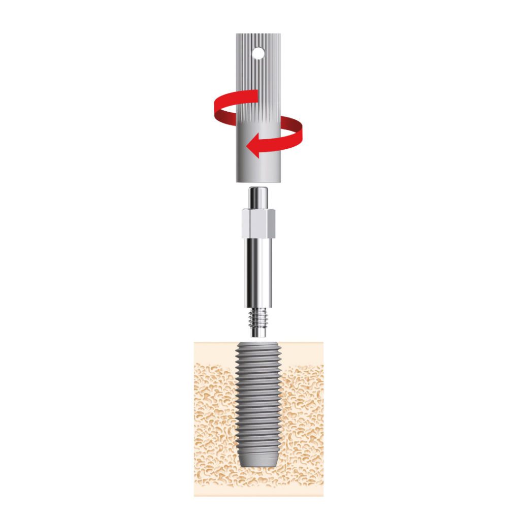 Osstell Smart pegs to suit various Implant types - presidental