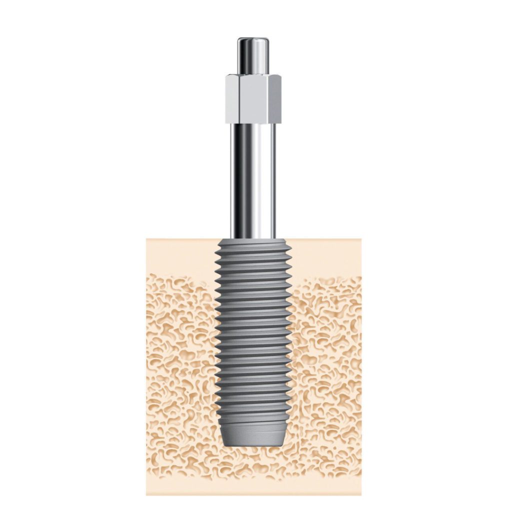 Osstell Smart pegs to suit various Implant types - presidental